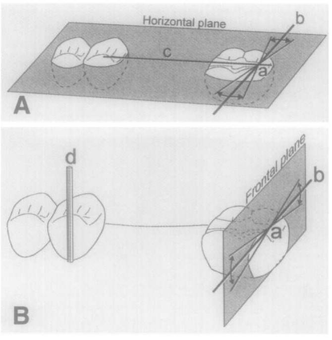 (PDF) Unilateral rotational path removable partial dentures for tilted ...