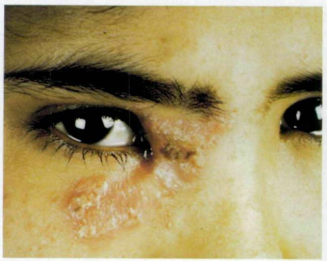 (PDF) Scrofuloderma (tuberculosis colliquativa cutis)