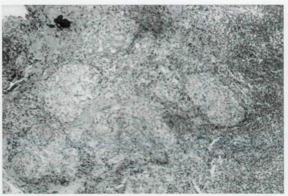 (PDF) Scrofuloderma (tuberculosis colliquativa cutis)